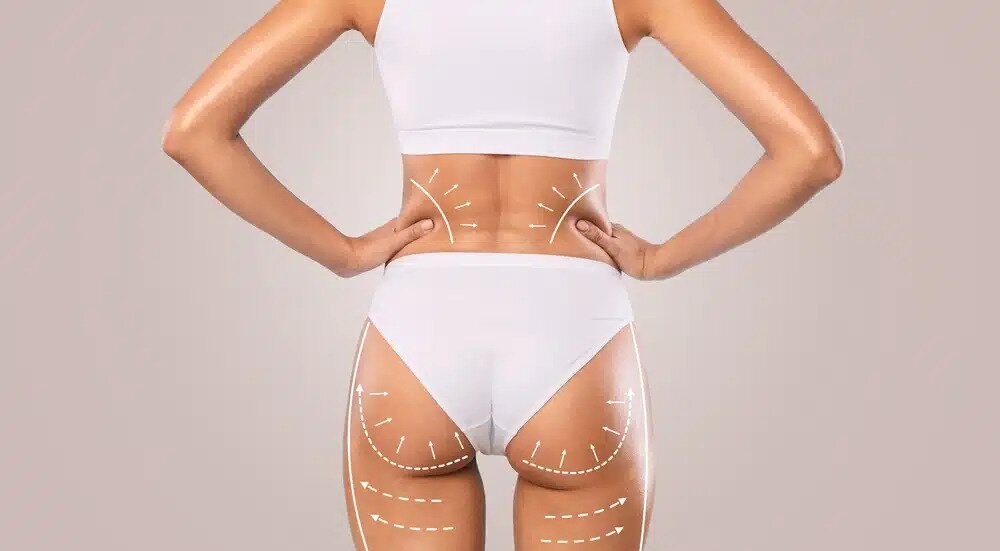 Sculptra BBL vs. Traditional Butt Lift | Aespala Medspa & Plastic